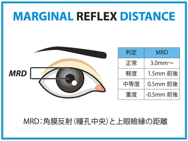眠そうな目は眼瞼下垂が原因かも！手術で改善可能