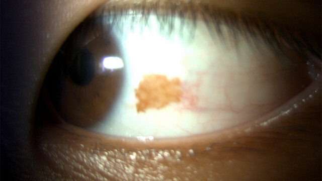 流行性角結膜炎（EKC） - 浜松市の高田眼科